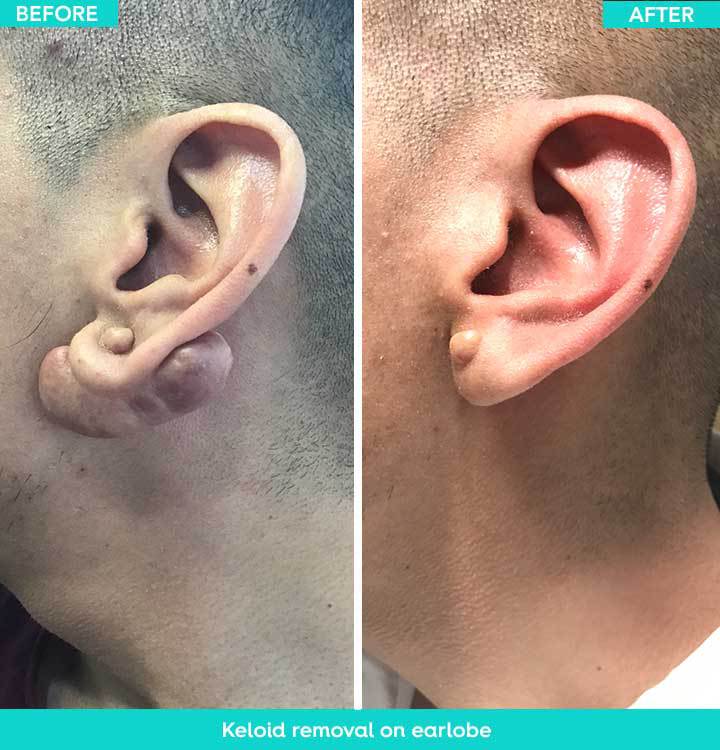 Miami Keloid Removal & Treatment | Arviv Medical Aesthetics