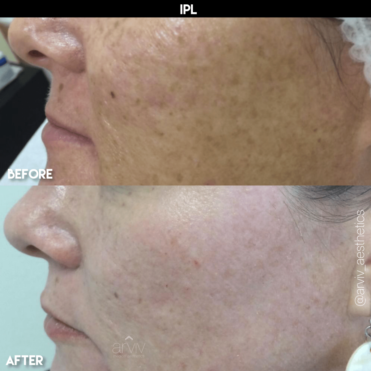 Intense Pulse Light Treatment in Miami | Arviv Medical Aesthetics