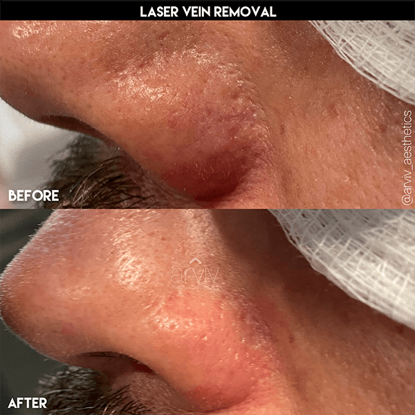 Laser Vein Removal in Ocala, FL - Varicose & Spider Veins | Arviv ...