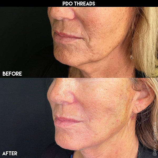 PDO Thread Lift in Ocala, FL: Before and After Pictures | Arviv Medical ...