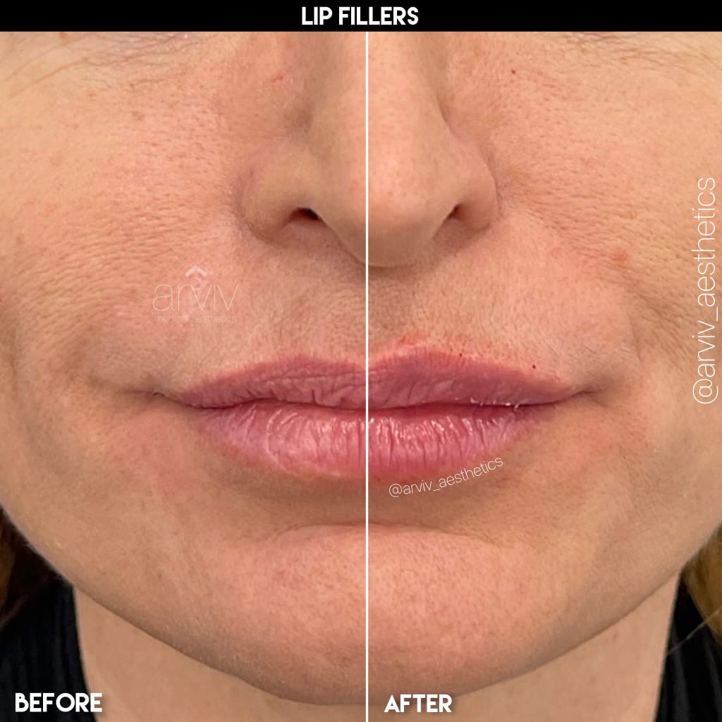 Dermal Fillers & Lip Injections in Tampa, FL | Arviv Medical Aesthetics
